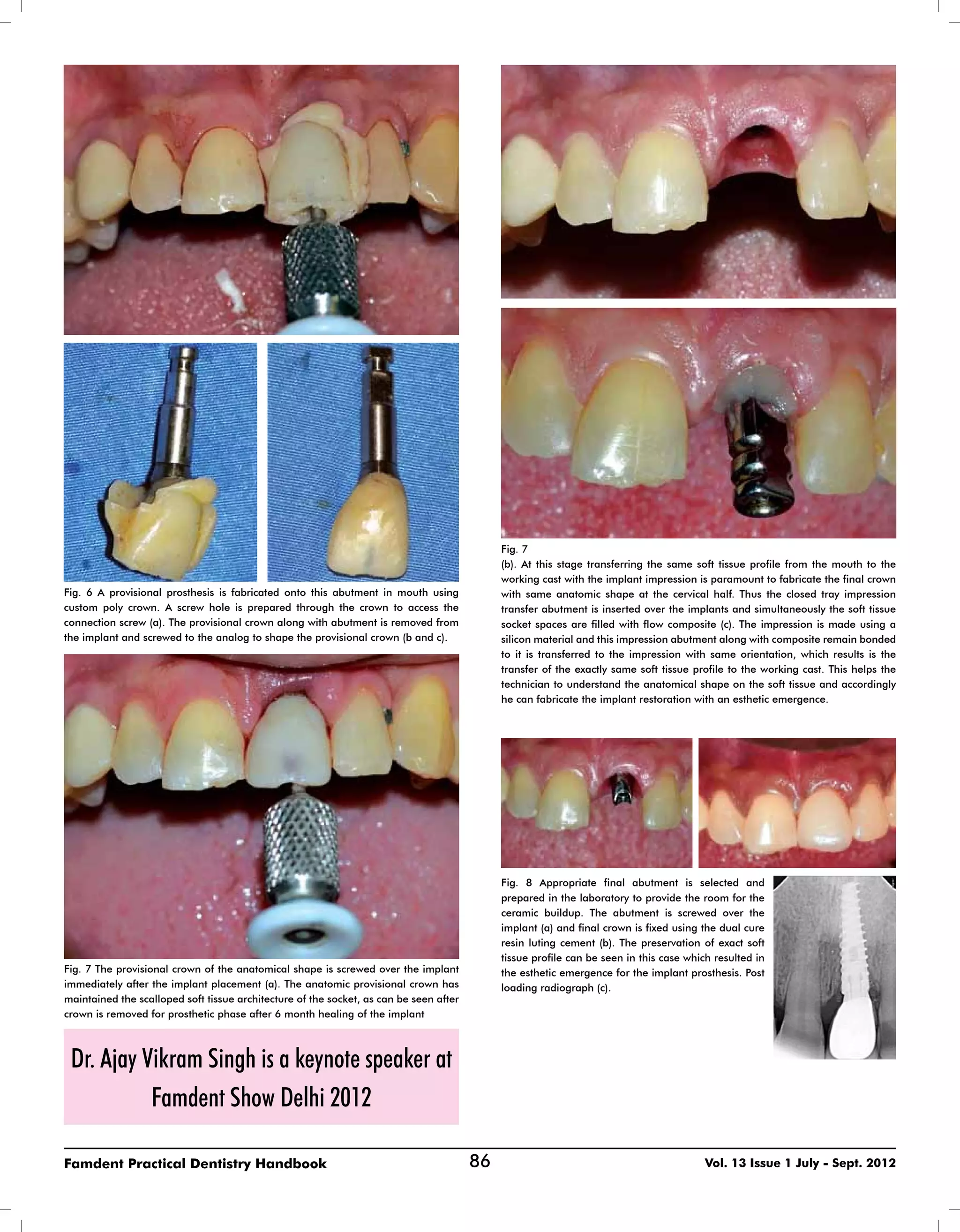 Management of soft tissue aesthetics in implant- D | PDF