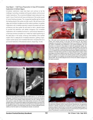Management of soft tissue aesthetics in implant- D | PDF
