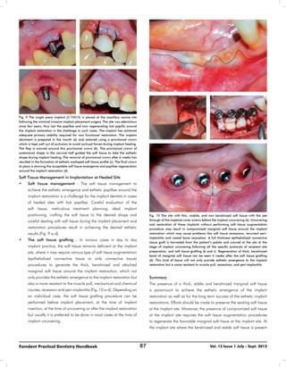 Management of soft tissue aesthetics in implant- D | PDF
