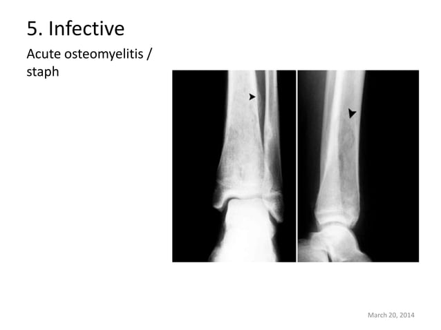 Dr.laith notes about common causes of periosteal reaction