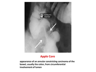 Dr.laith notes about common radiological signs | PPTX