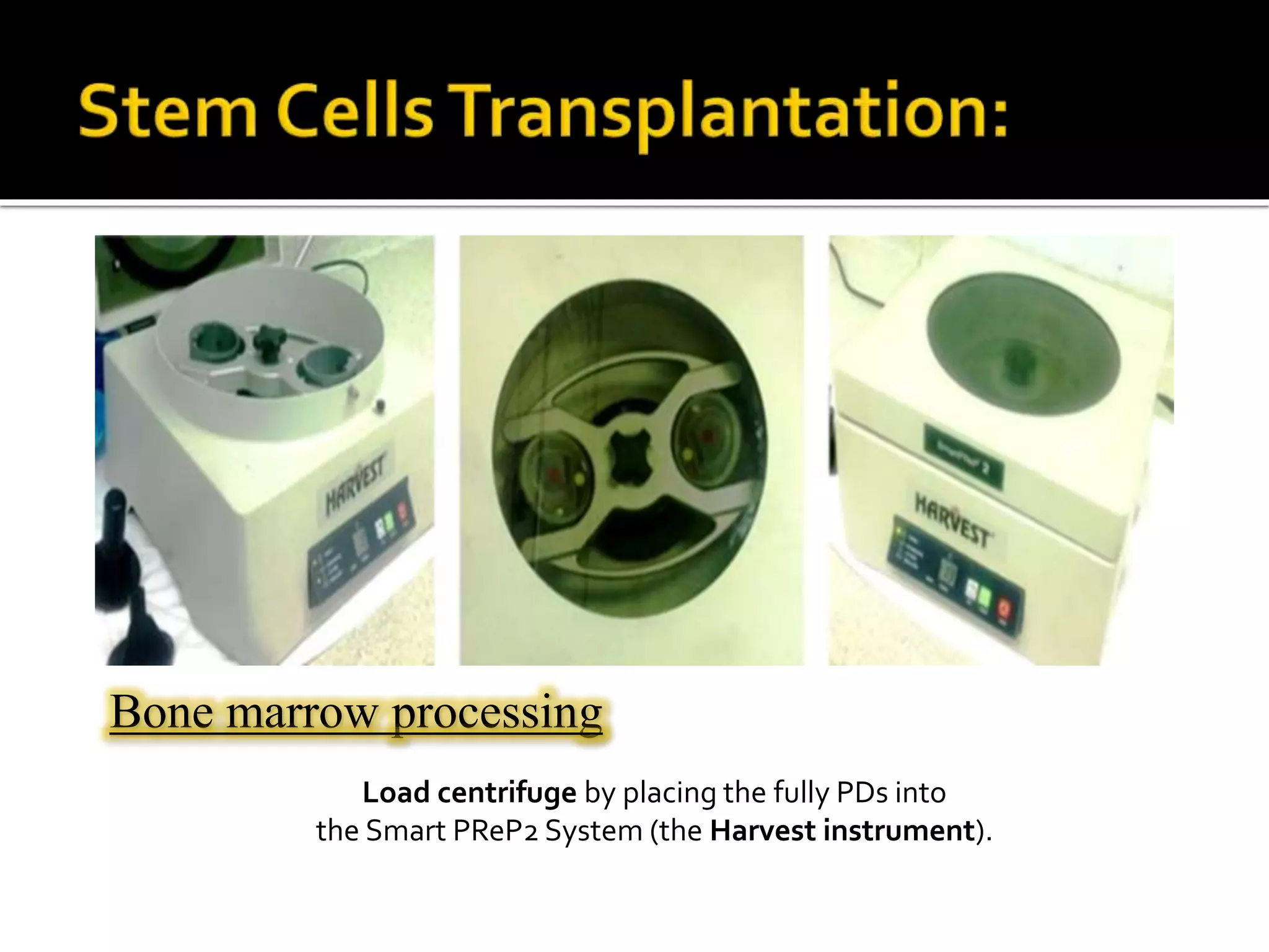 Role of Stem Cell Transplantation in the Treatment of Ulcerative ...
