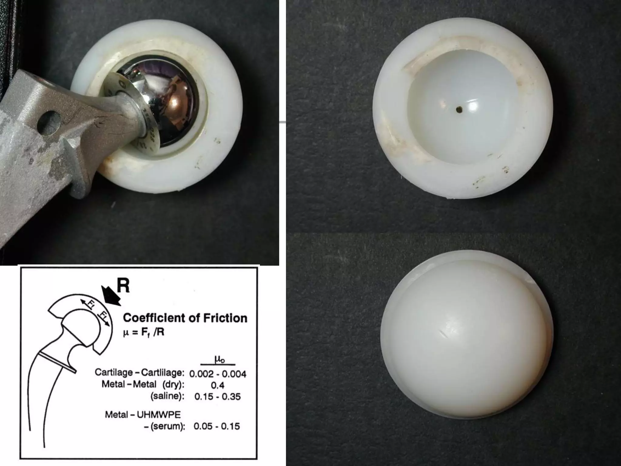 Highly Crosslinked UHMWPE In THR TKR ARTHROPLASTY (Polyethylene ),DR ...