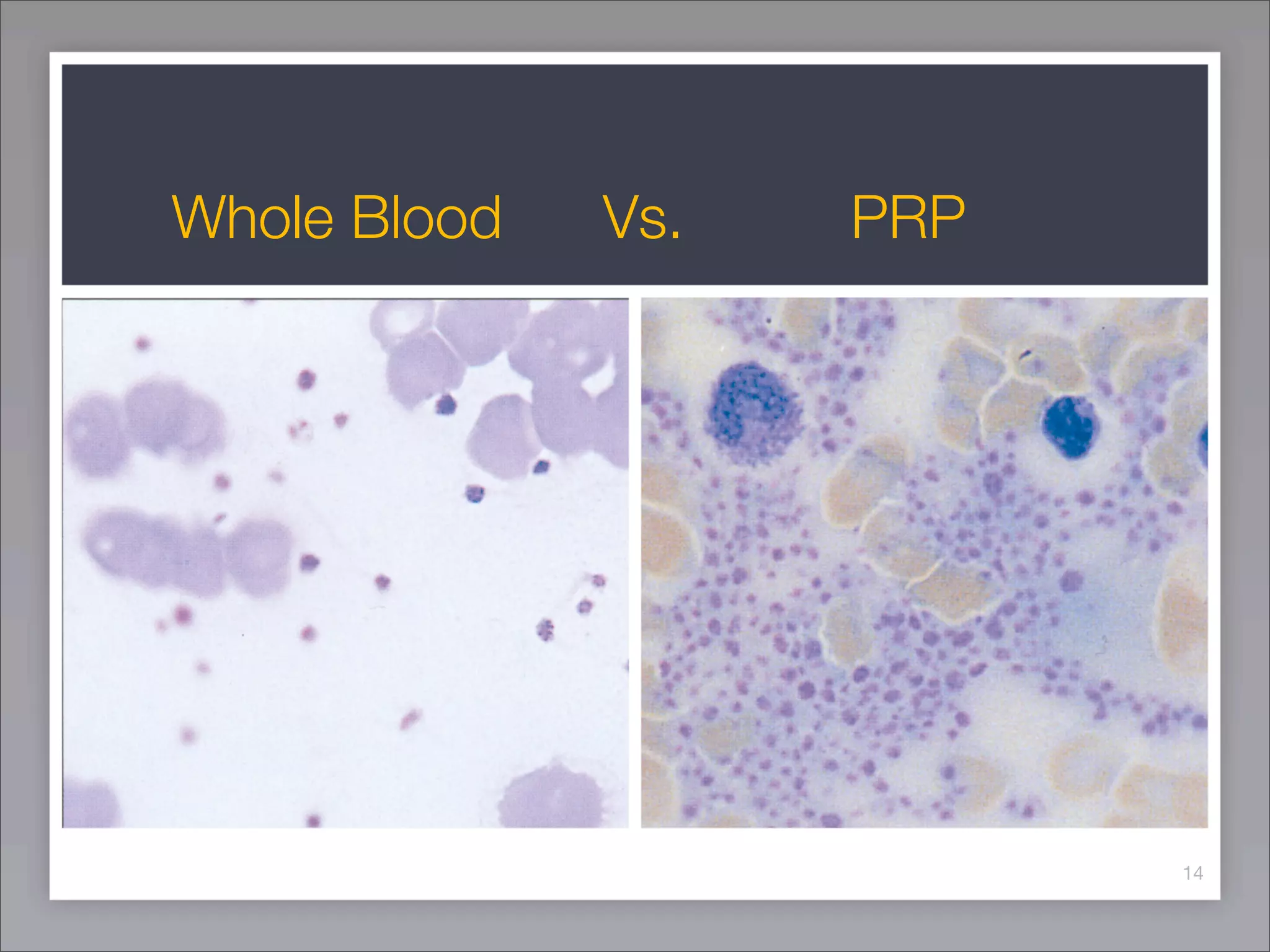 Jason G. Attaman, DO, FAAPMR Presents: Image Guided Platelet Rich ...
