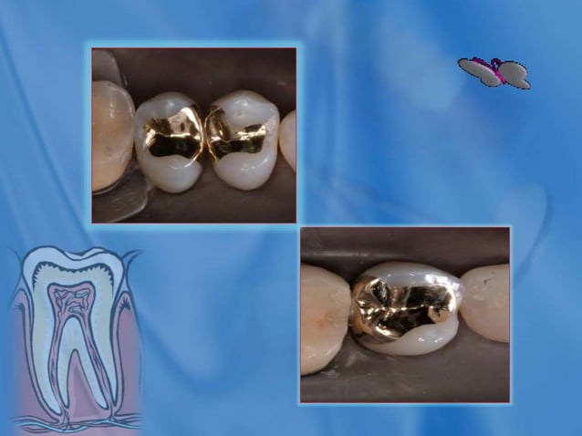 class II cast metal restorations | PPTX