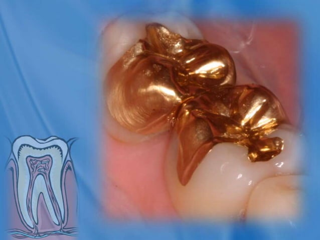 class II cast metal restorations | PPTX