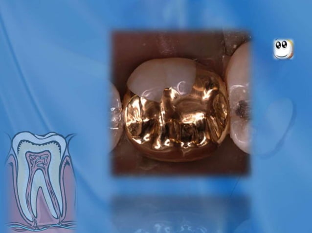 class II cast metal restorations | PPTX