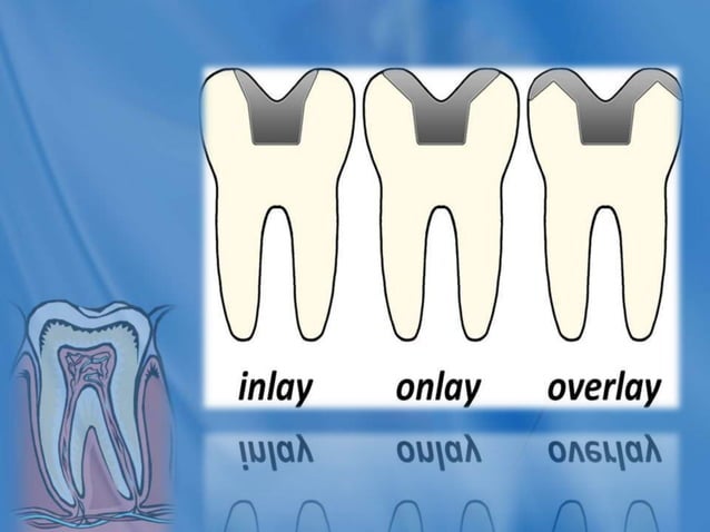 class II cast metal restorations | PPTX
