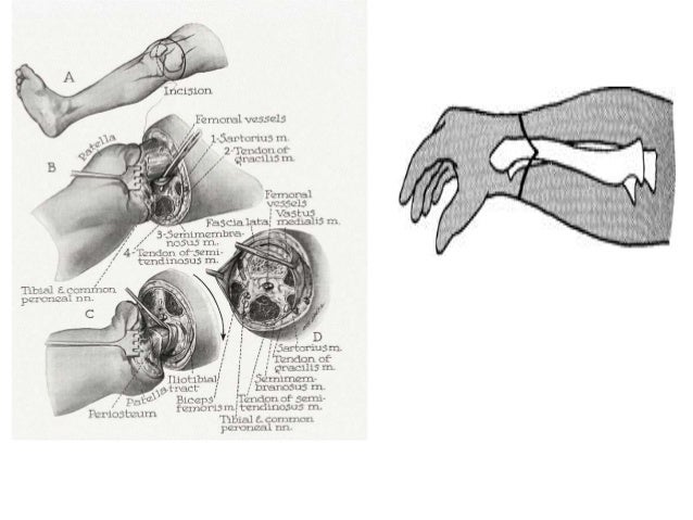 Dr.guruprasad amputation