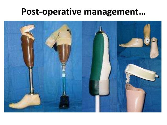 Dr.guruprasad amputation