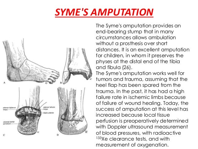 Dr.guruprasad amputation