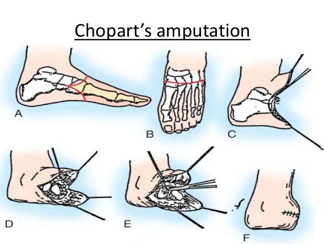 Dr.guruprasad amputation
