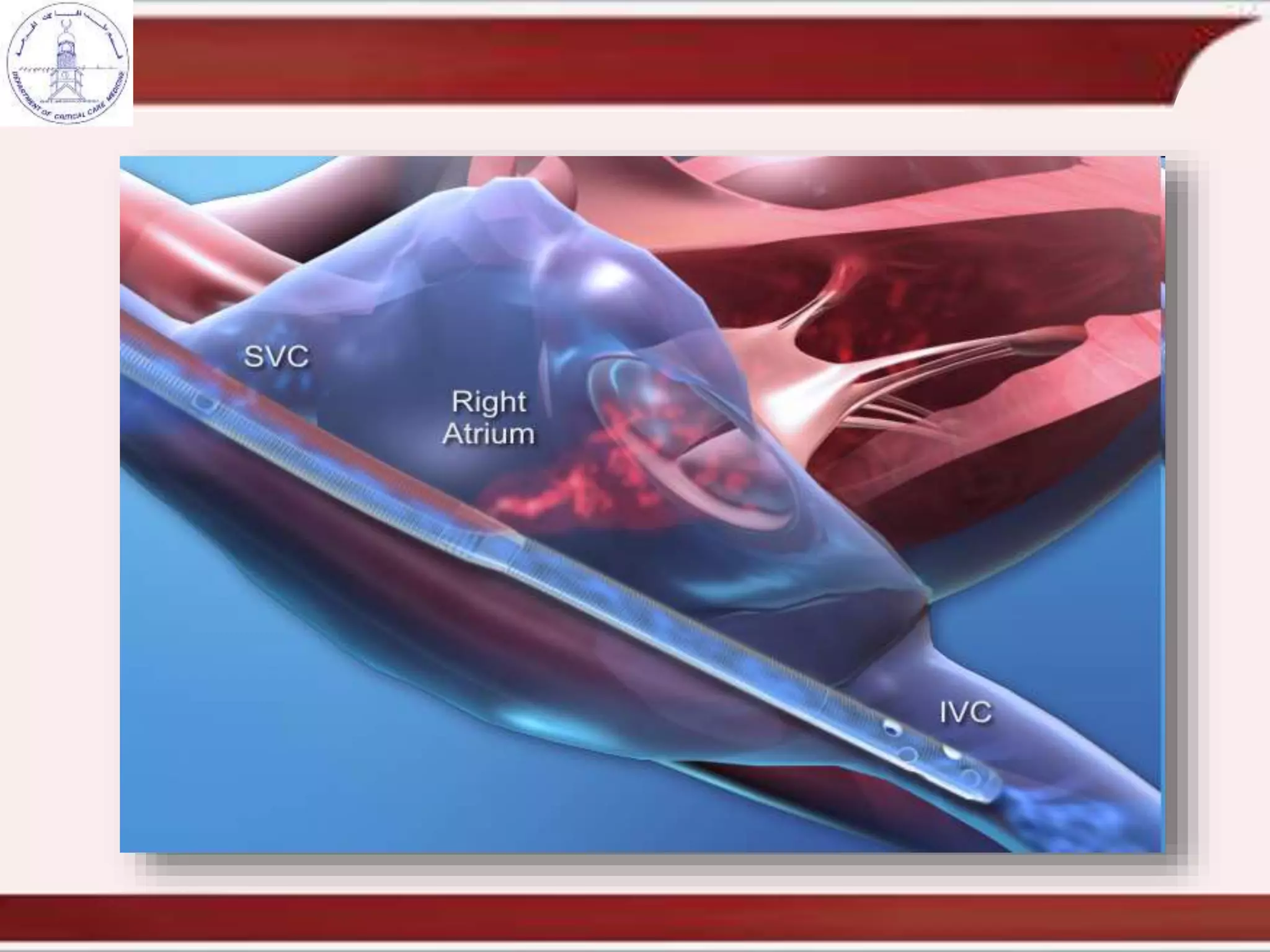 cannulation and recirculation in vv ecmo | PPTX