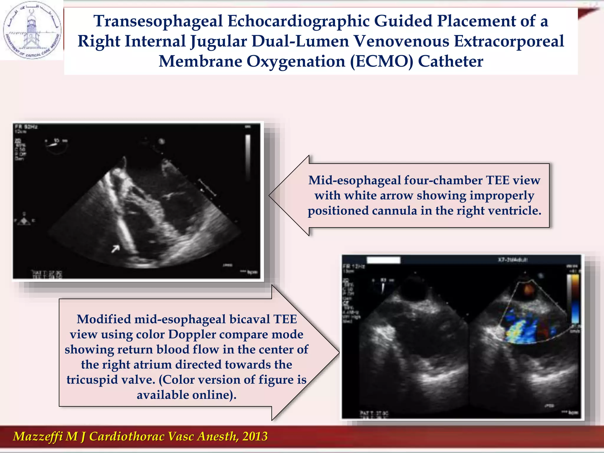 cannulation and recirculation in vv ecmo | PPTX