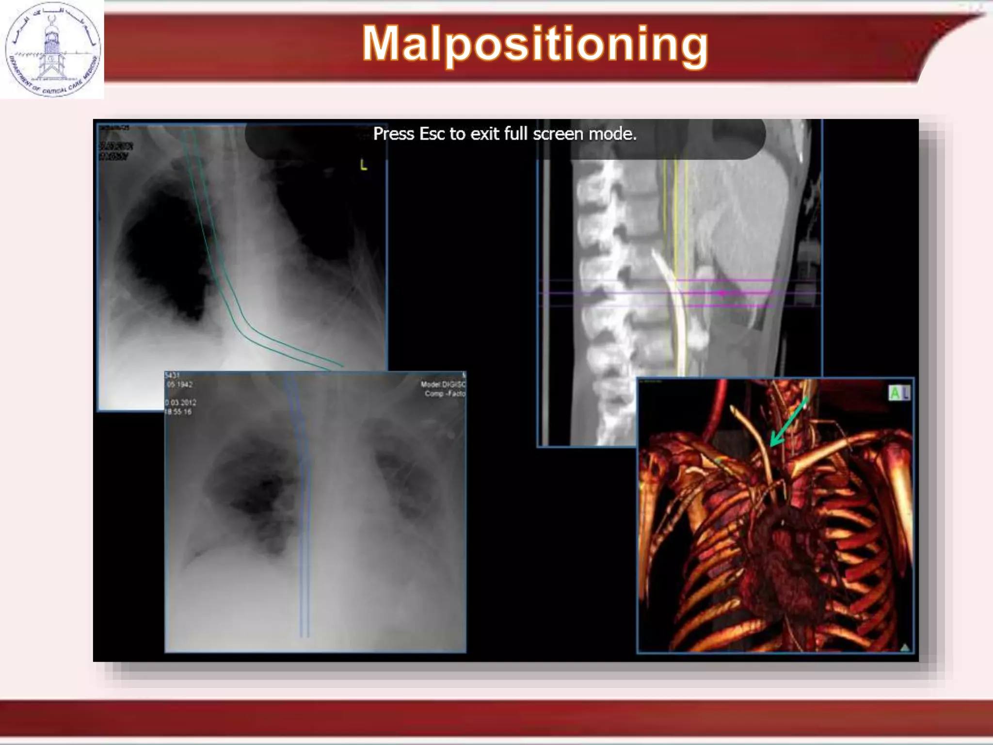cannulation and recirculation in vv ecmo | PPTX