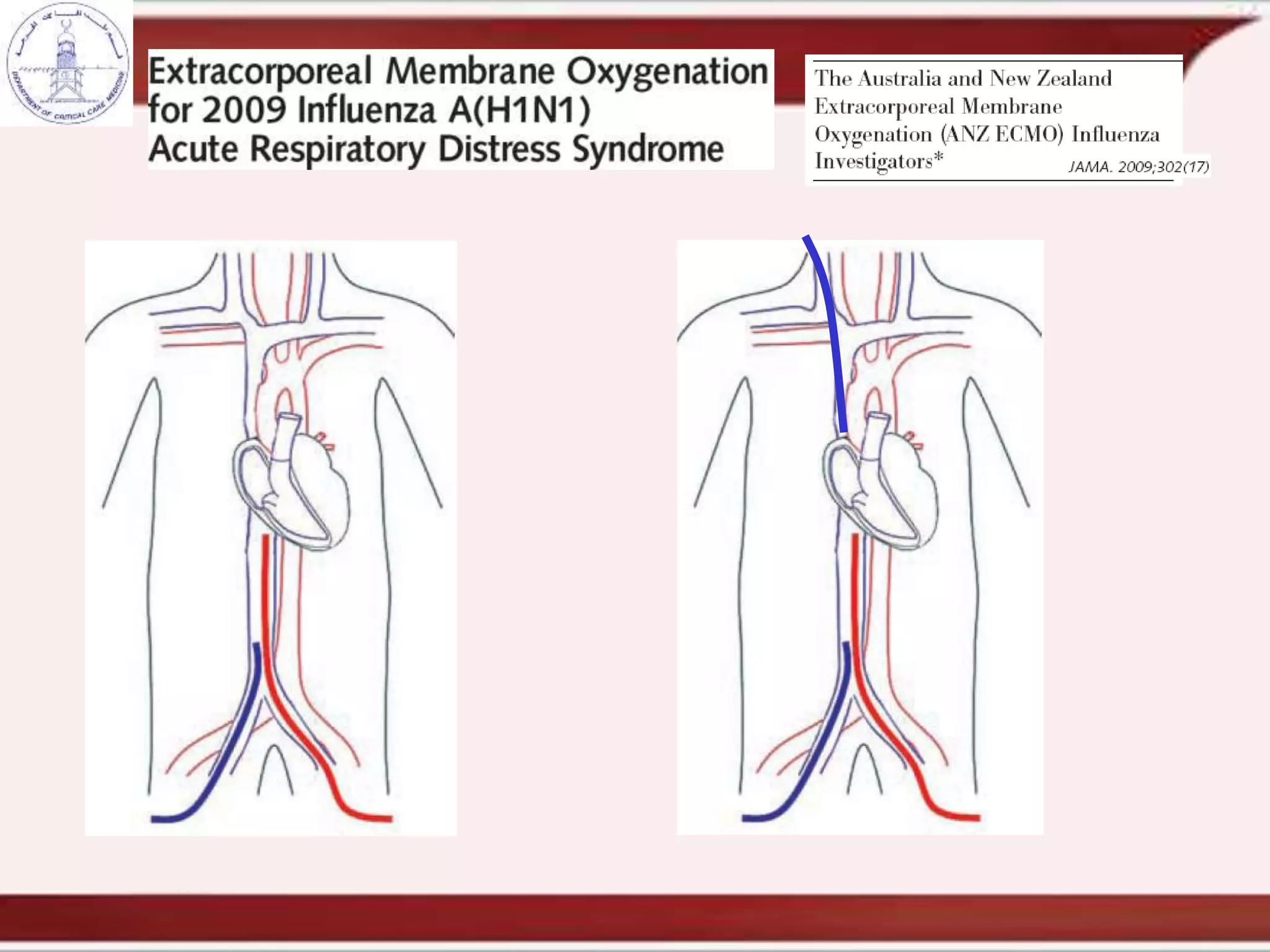 cannulation and recirculation in vv ecmo | PPTX