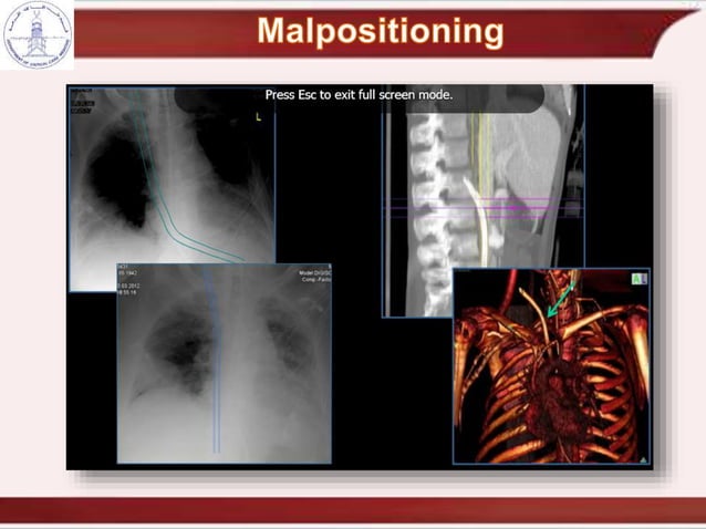 cannulation and recirculation in vv ecmo | PPTX | First Aid | Injuries