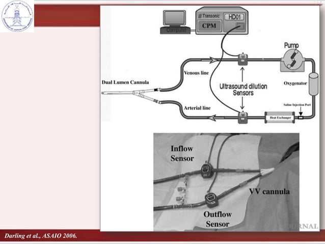 cannulation and recirculation in vv ecmo | PPTX | First Aid | Injuries