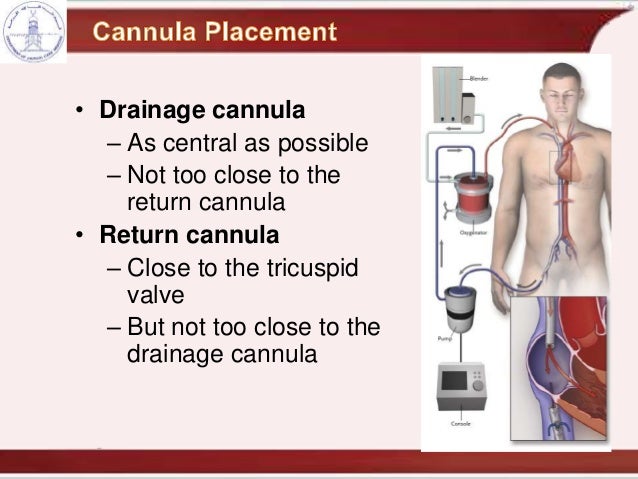 cannulation and recirculation in vv ecmo