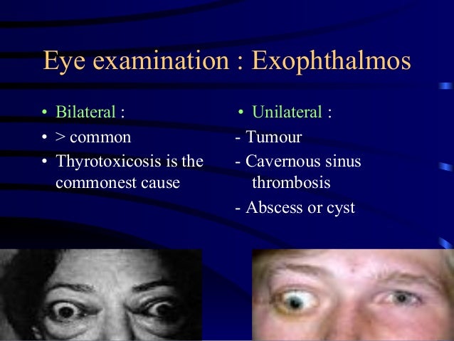 Exophthalmos Unilateral Disorders and conditions of the eye