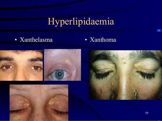 Xanthomas Causes