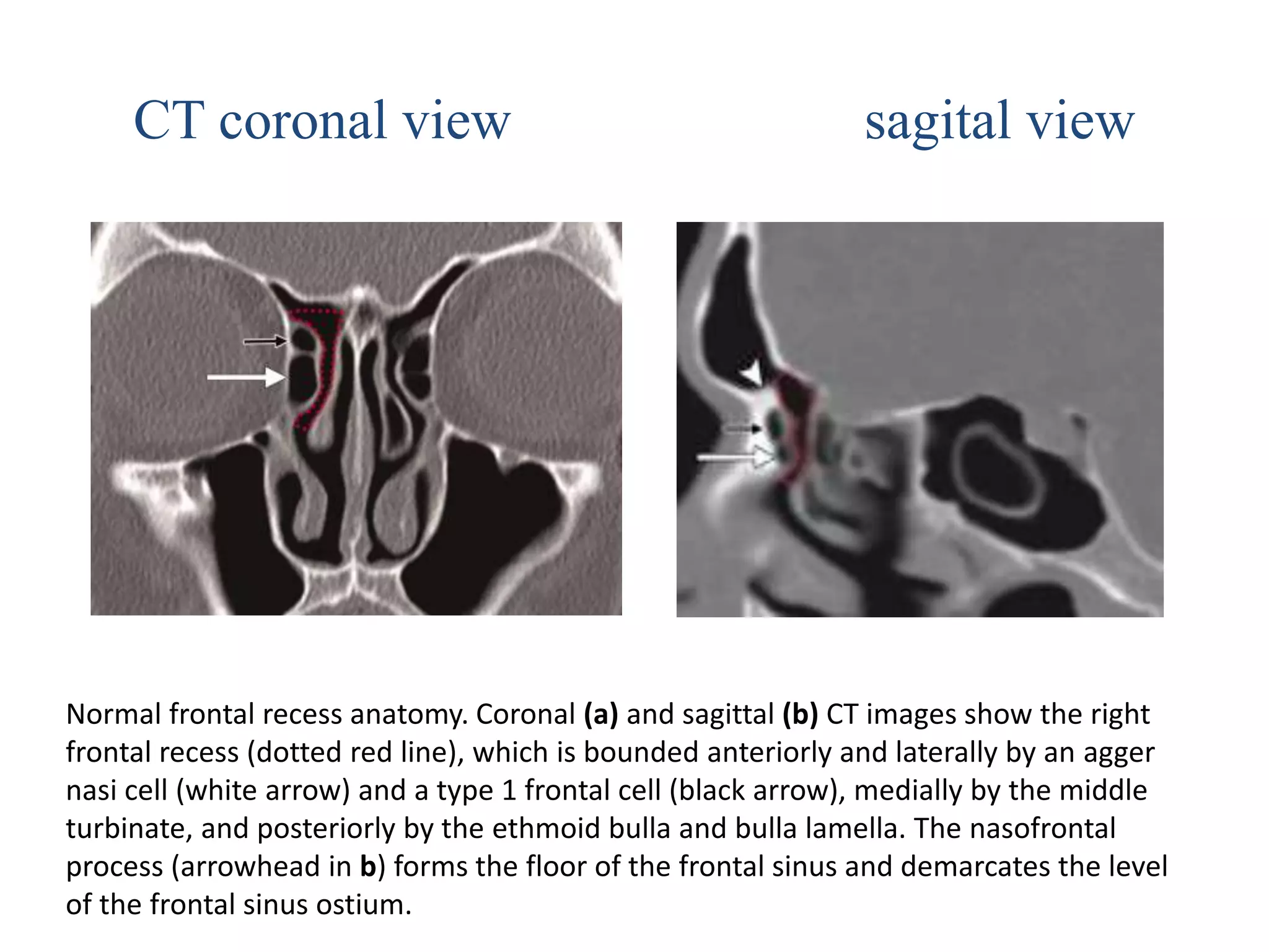 surgical approaches to frontal sinus ppt | PPTX