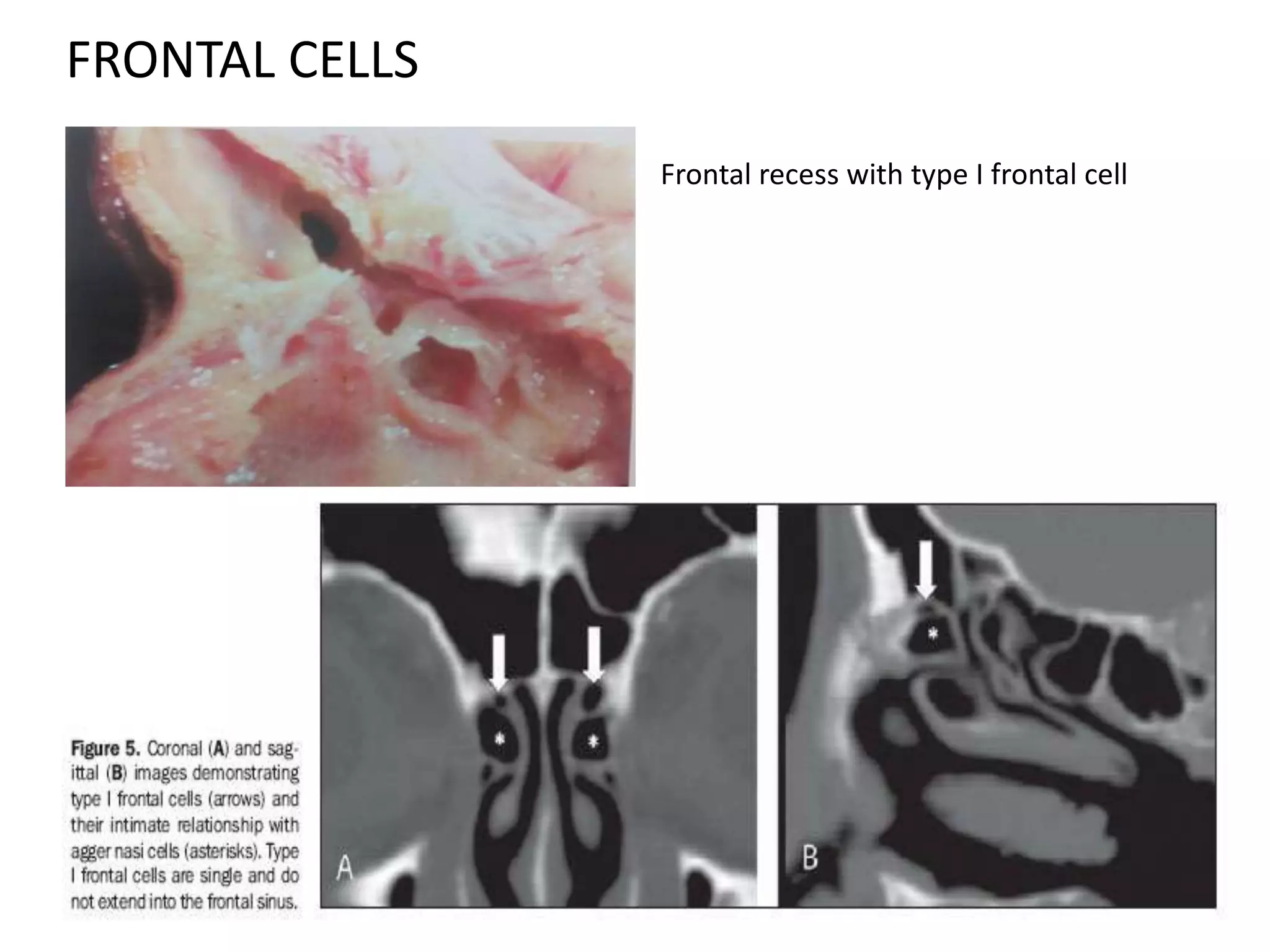 surgical approaches to frontal sinus ppt | PPTX