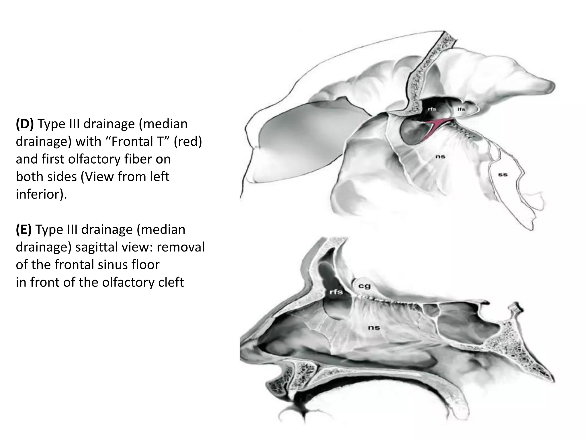 surgical approaches to frontal sinus ppt | PPTX