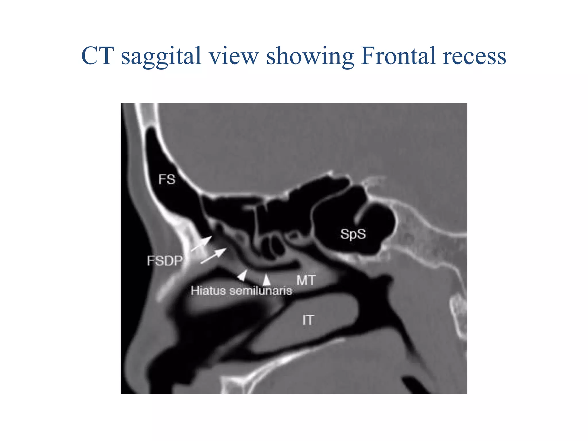 surgical approaches to frontal sinus ppt | PPTX