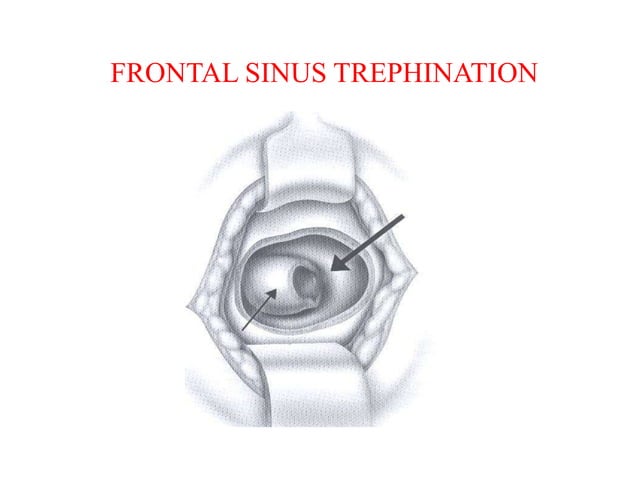 Surgical Approaches To Frontal Sinus Ppt Ppt