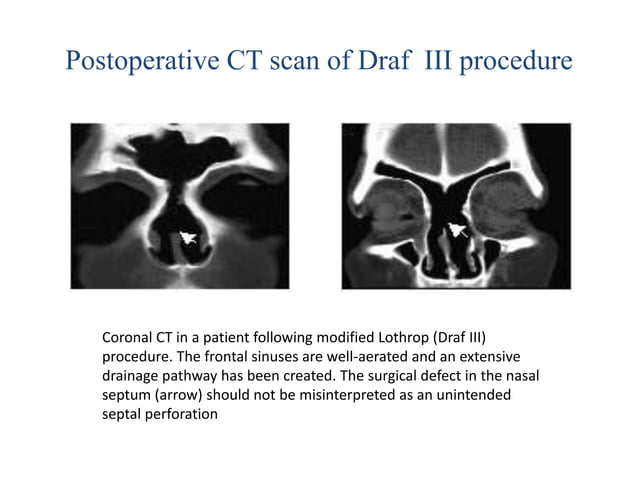Surgical Approaches To Frontal Sinus Ppt Ppt