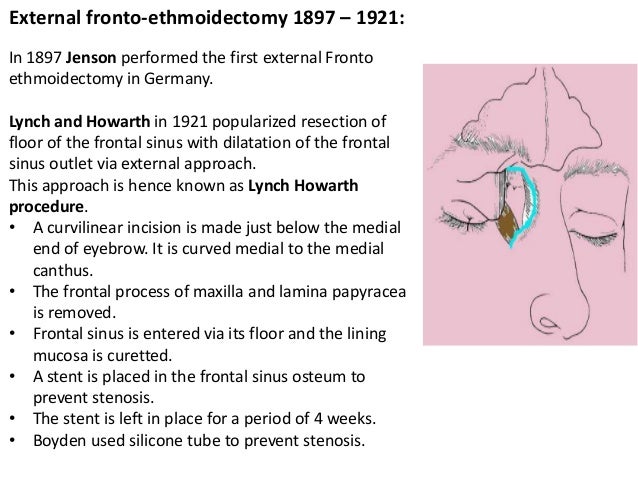 surgical approaches to frontal sinus ppt
