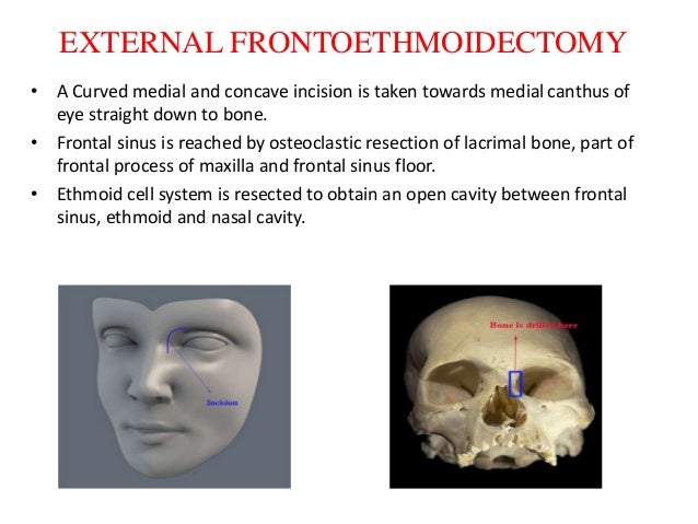 surgical approaches to frontal sinus ppt