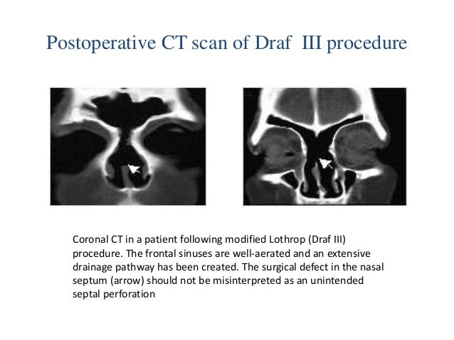 surgical approaches to frontal sinus ppt