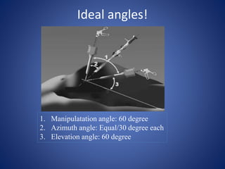 Laparoscopy & its Ergonomics by Dr.Mohammad Zarin | PPT