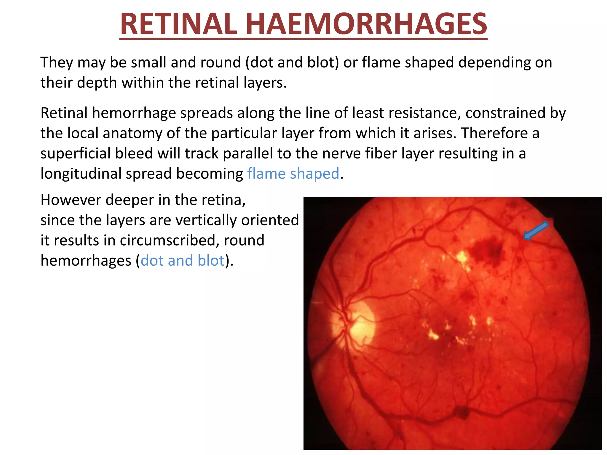 Diabetic retinopathy | PPTX