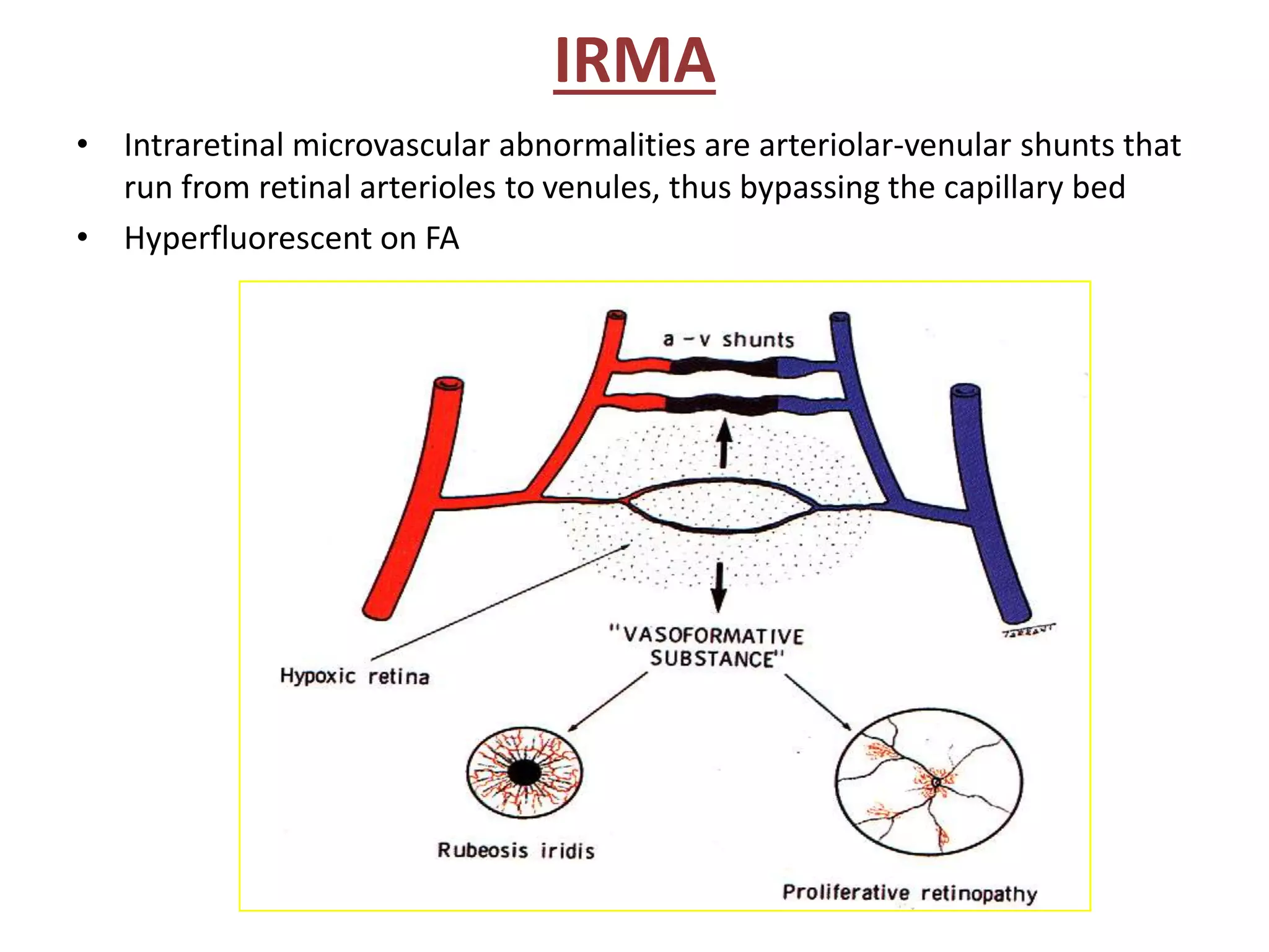 Diabetic retinopathy | PPTX