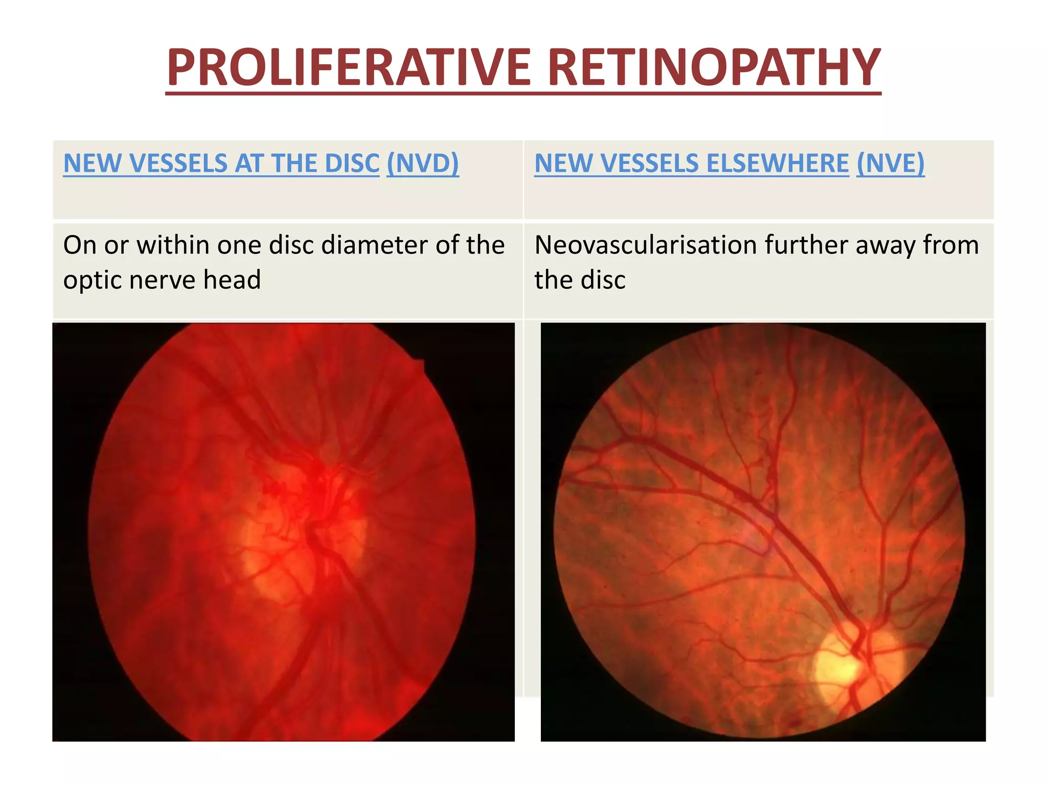 Diabetic retinopathy | PPTX