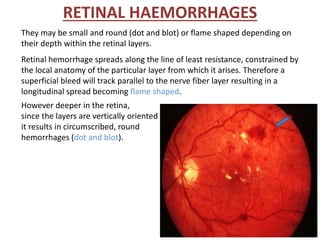 Diabetic retinopathy | PPT