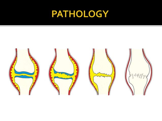 Bone Infections | PPT