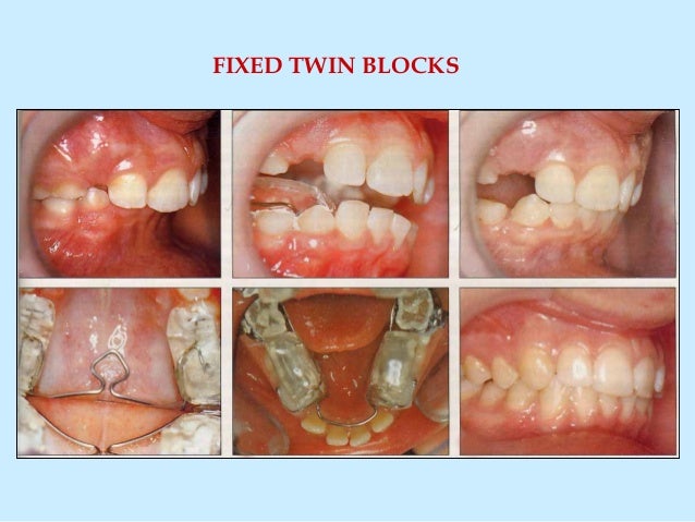 Twin block / fixed orthodontics courses