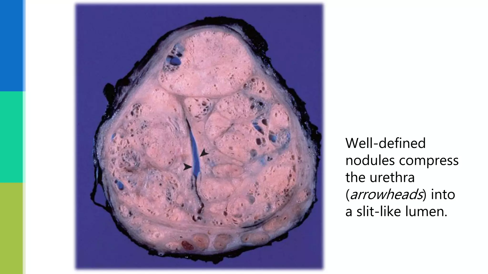 BPH- Pathology & Investigations | PPTX