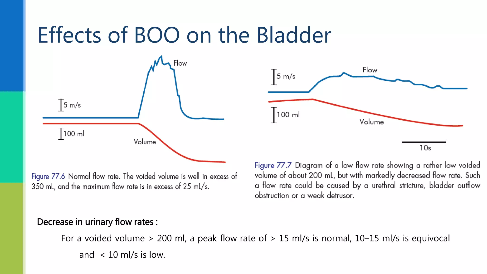 BPH- Pathology & Investigations | PPTX