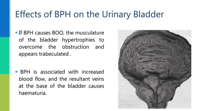 BPH- Pathology & Investigations | PPTX | Sexual Conditions | Sexual Health