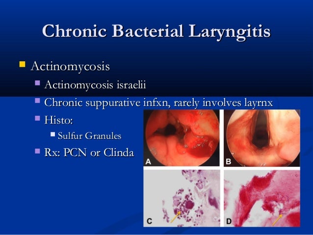 Dr.vijaysundaram,acute & chronic infections larynx ,12.09.16