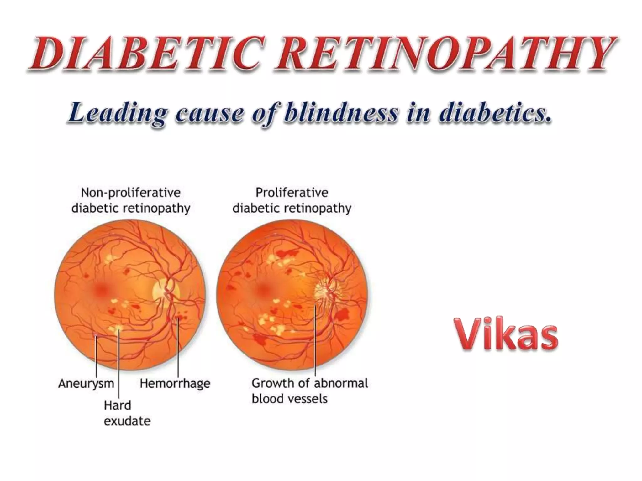 Diabetic Retinopathy (Molecular mechanisms,types,fundoscopy,diagnosis ...