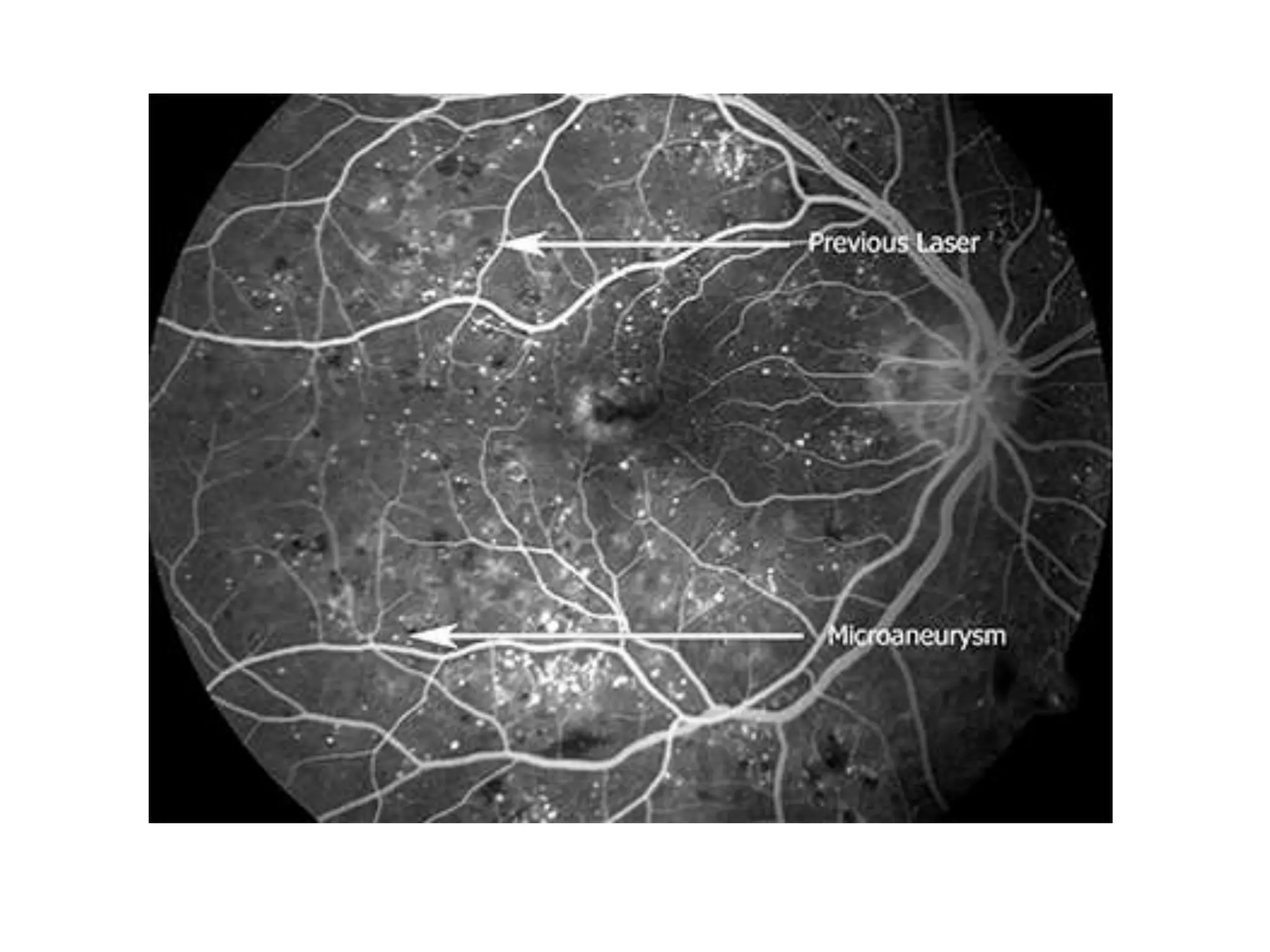 Diabetic Retinopathy (Molecular mechanisms,types,fundoscopy,diagnosis ...