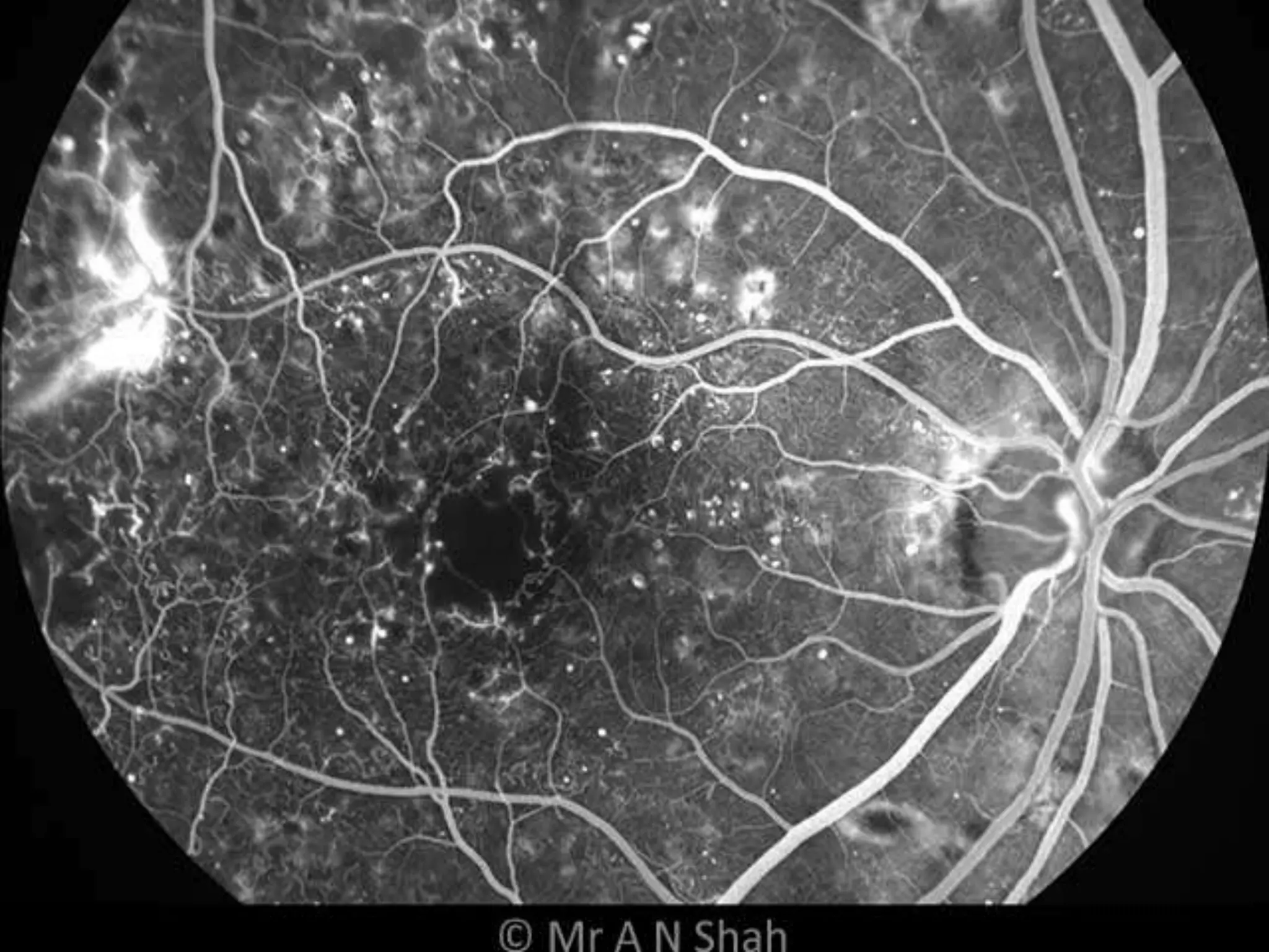 Diabetic Retinopathy (Molecular mechanisms,types,fundoscopy,diagnosis ...