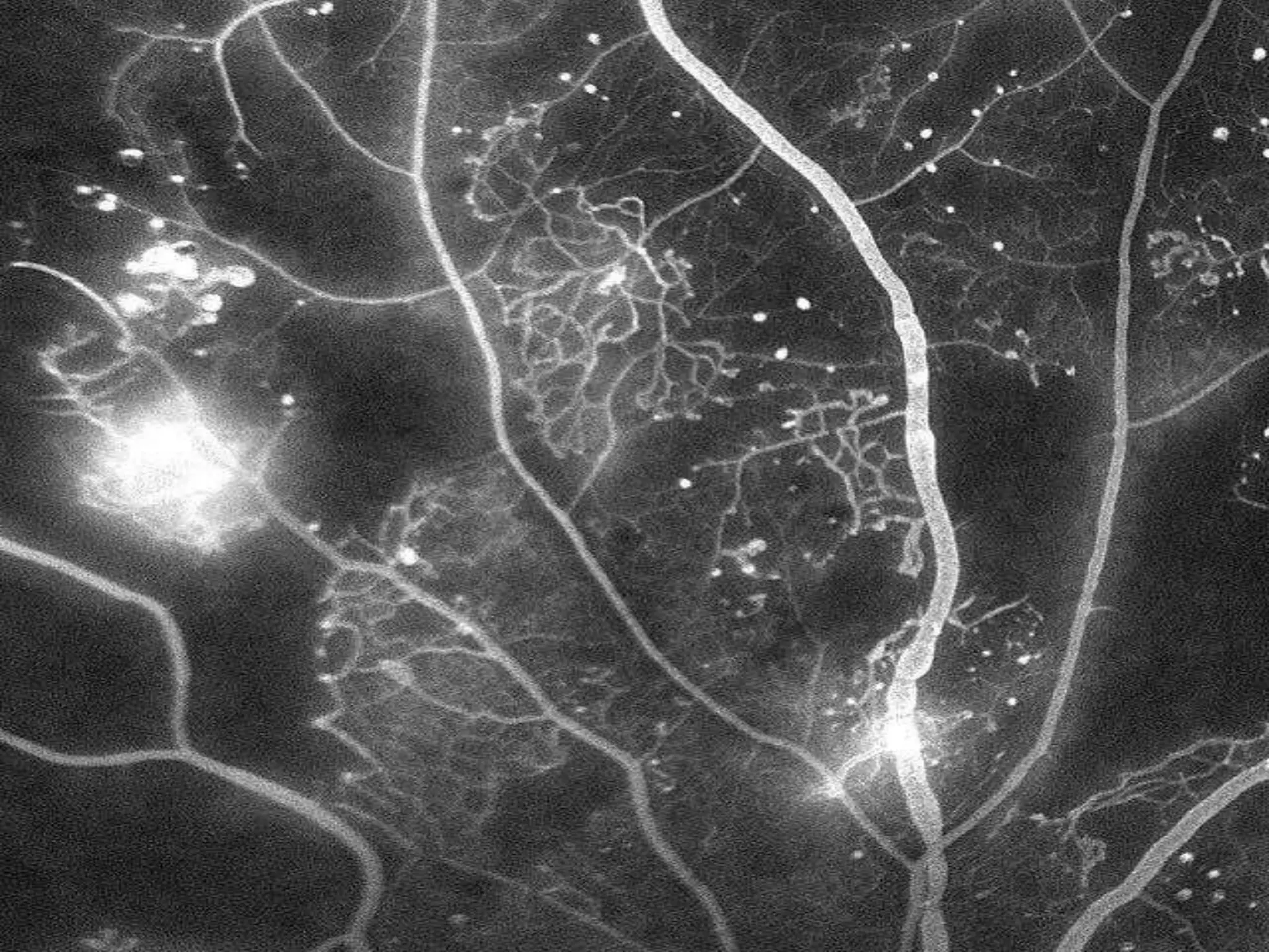 Diabetic Retinopathy (Molecular mechanisms,types,fundoscopy,diagnosis ...