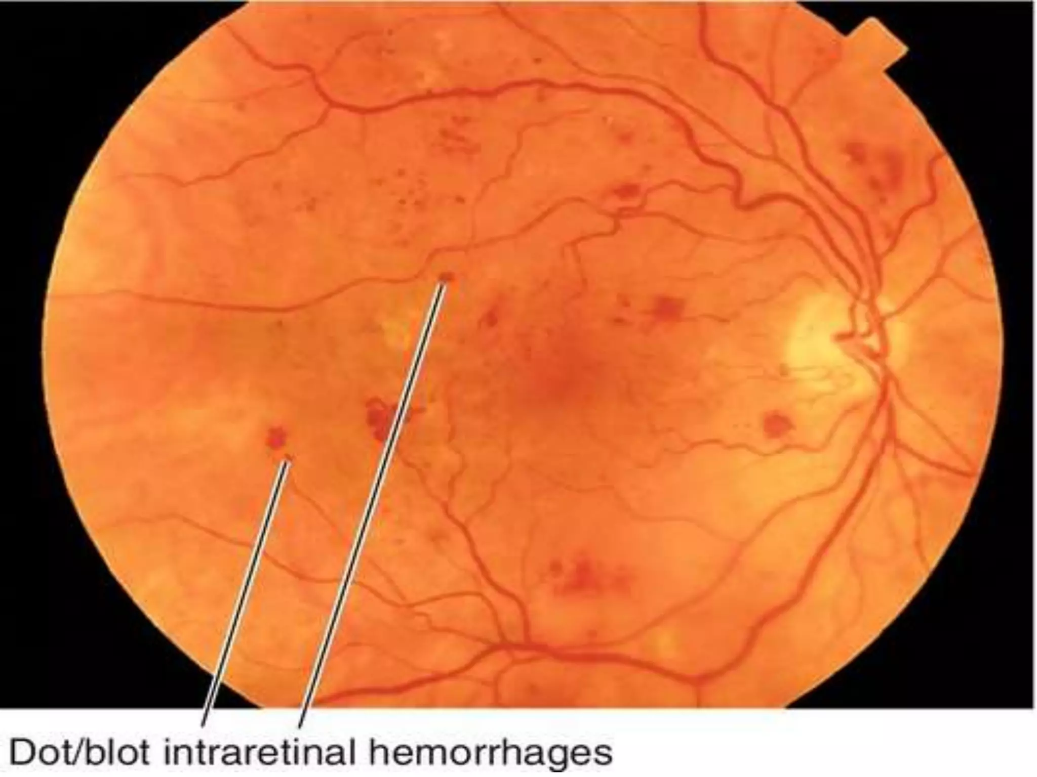 Diabetic Retinopathy (Molecular mechanisms,types,fundoscopy,diagnosis ...